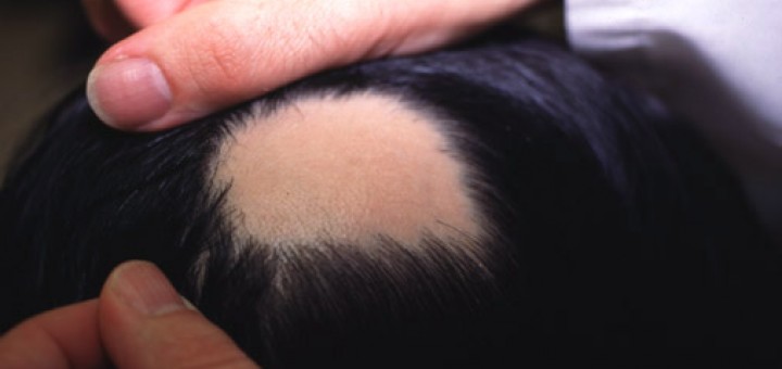 Dermatitis Seborreica | Recuperar el pelo | Alopecia Calvicie Pérdida ...